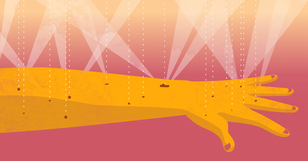 How Hormones Stained My Skin | Endometriosis.net